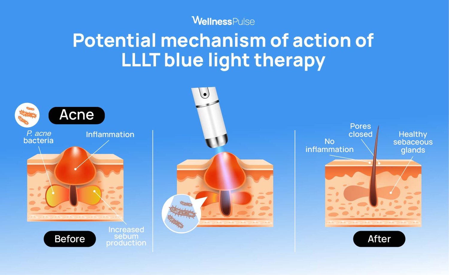 Exploring the Blue Light Therapy for Skin Health | WellnessPulse