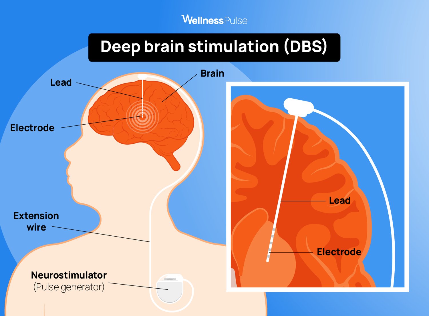Neurostimulator Systems: Types & Applications | WellnessPulse